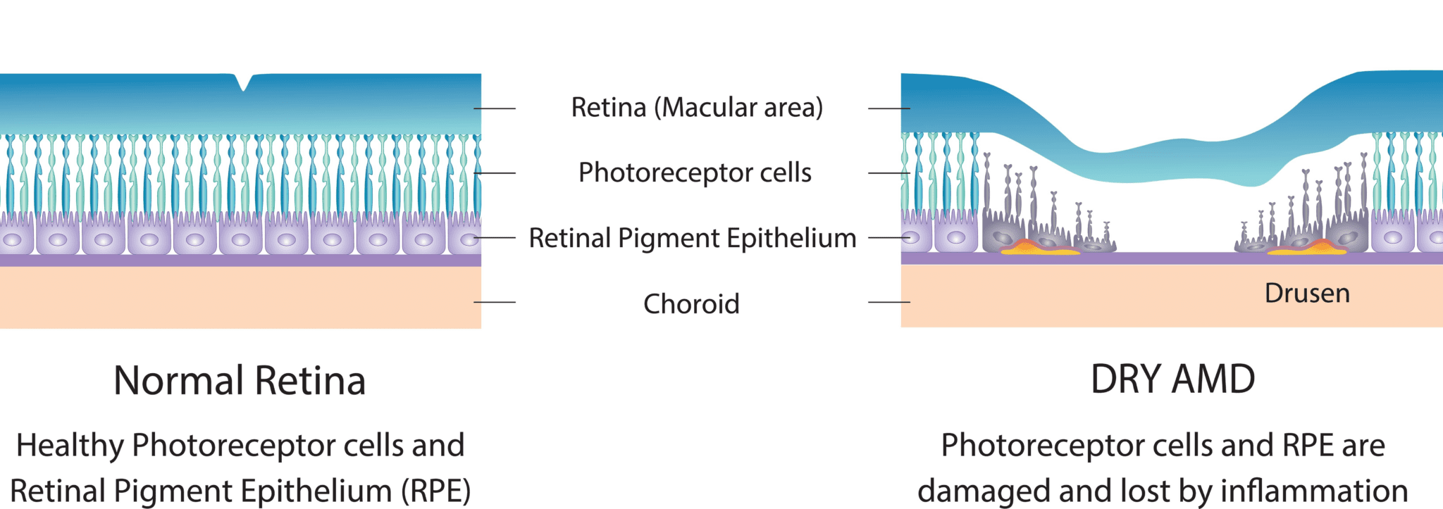 Dry Macular Degeneration - Symptoms and Treatments - AMDF